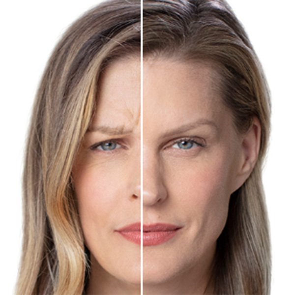 Botox® Treatments Dracut, MA | Botox | A Smoother You Inc